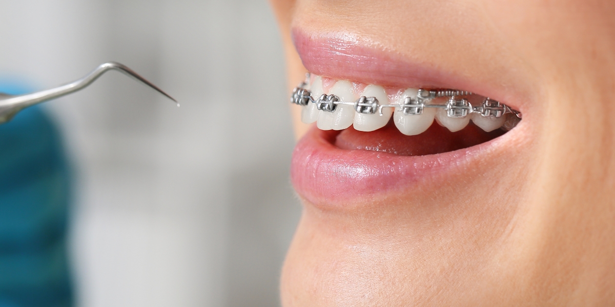 Smile Confidently With Invisible Braces In London: Your ICare Dental ...