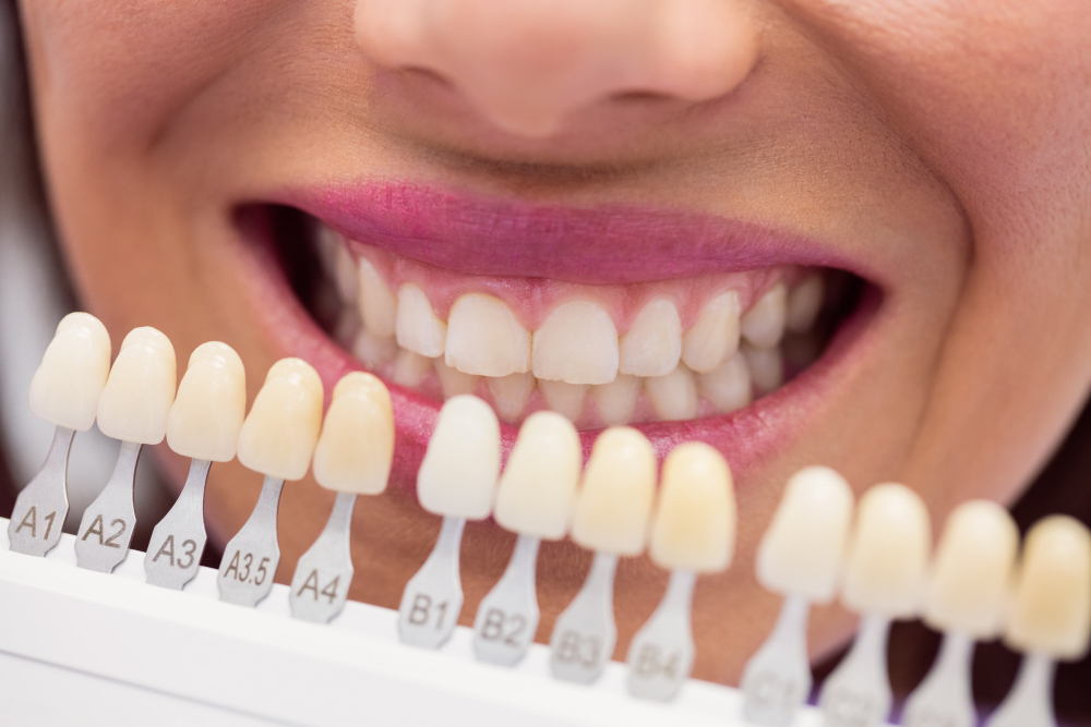 Experience The Luxury: Veneers Before And After | ICare Dental